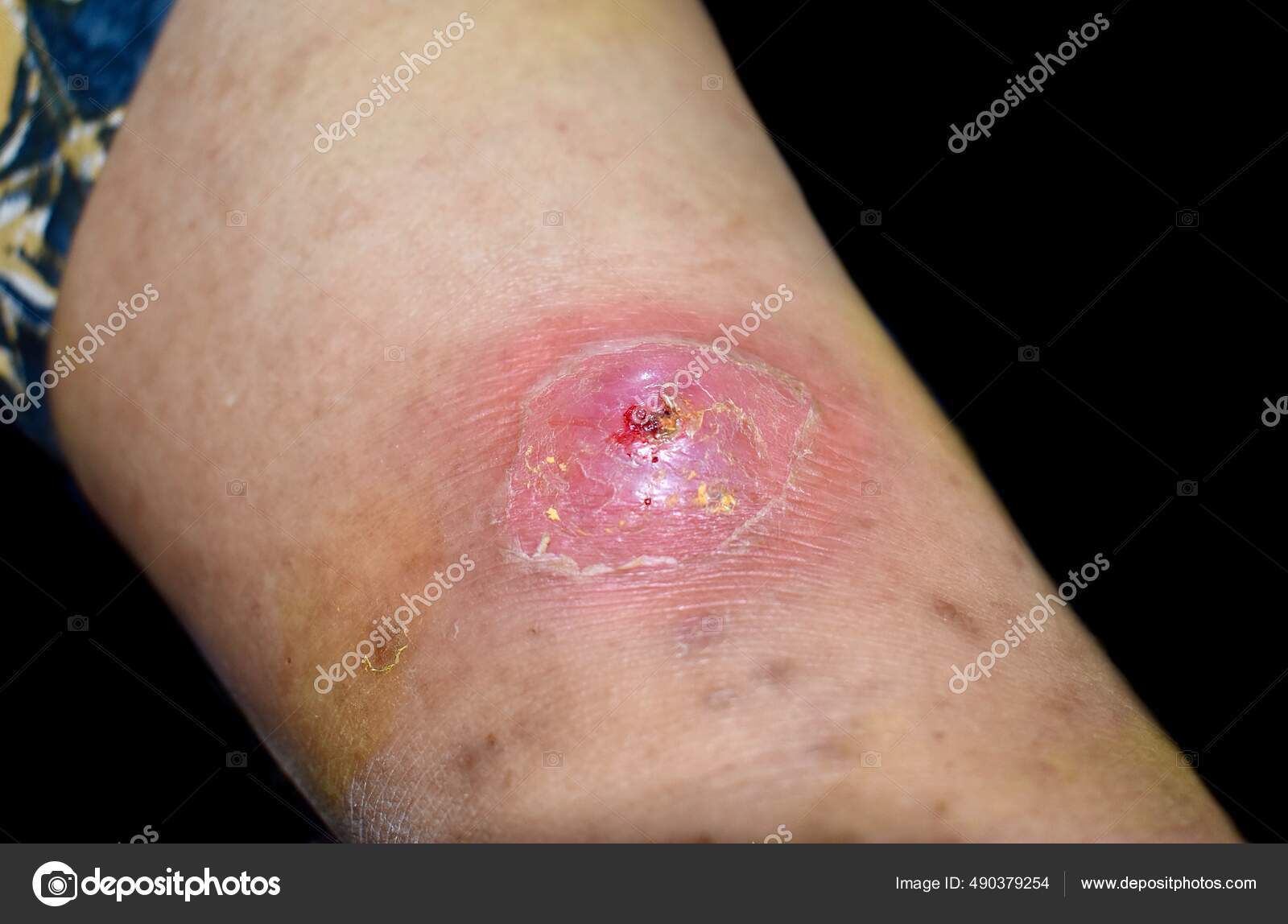 Impending Abscess Surrounding Cellulitis Staphylococcal Streptococcal ...