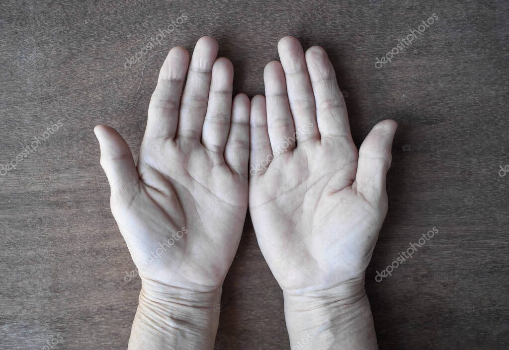 Superficie palmar pálida de ambas manos. Manos anémicas de asiática ...