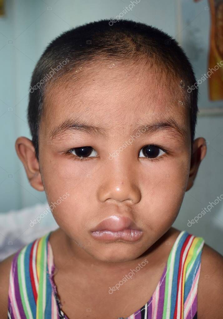 Angioedema en los párpados y labios del niño del sudeste asiático. Cara ...