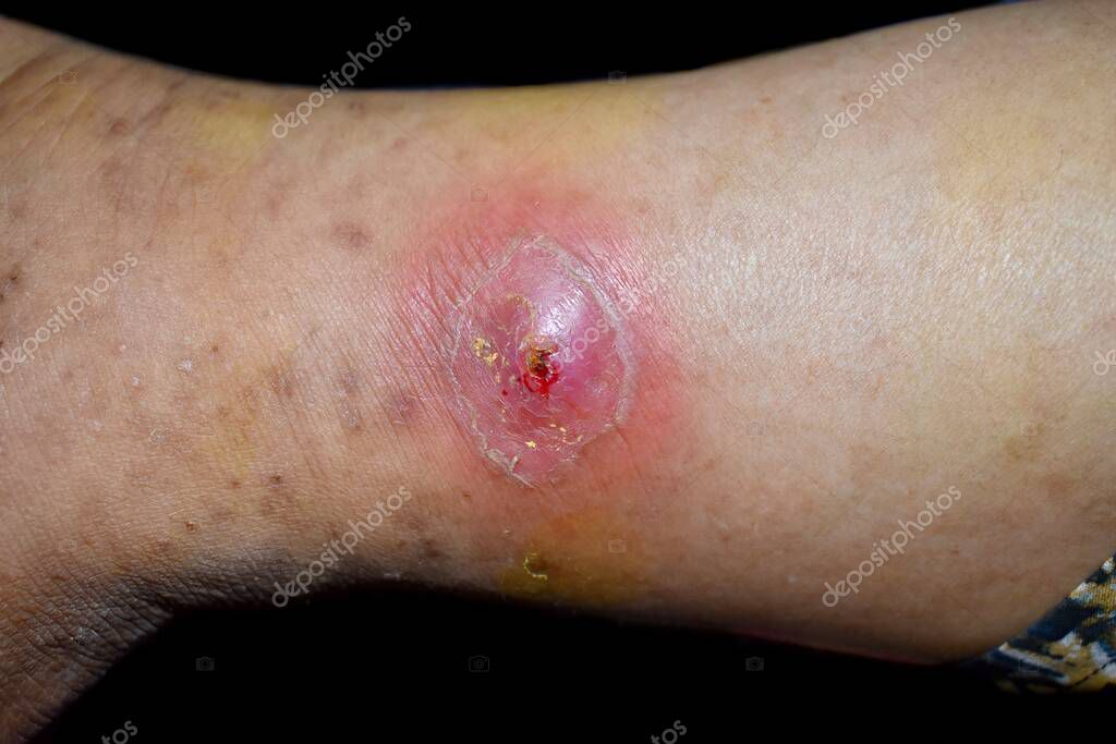 Absceso inminente con celulitis circundante o infección de piel ...