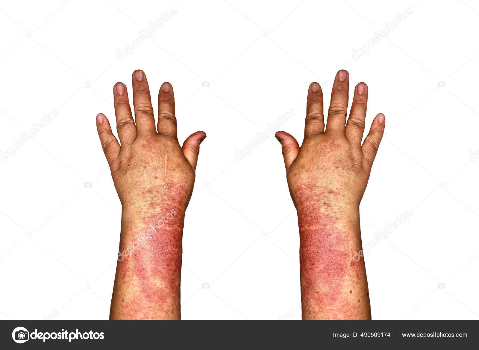 Bilateral Edema Upper Limbs Swollen Hands Arms Asian Woman Isolated ...