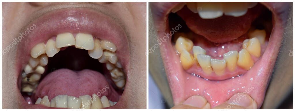 Stacked bad teeth Pictures, Stacked bad teeth Stock Photos & Images ...