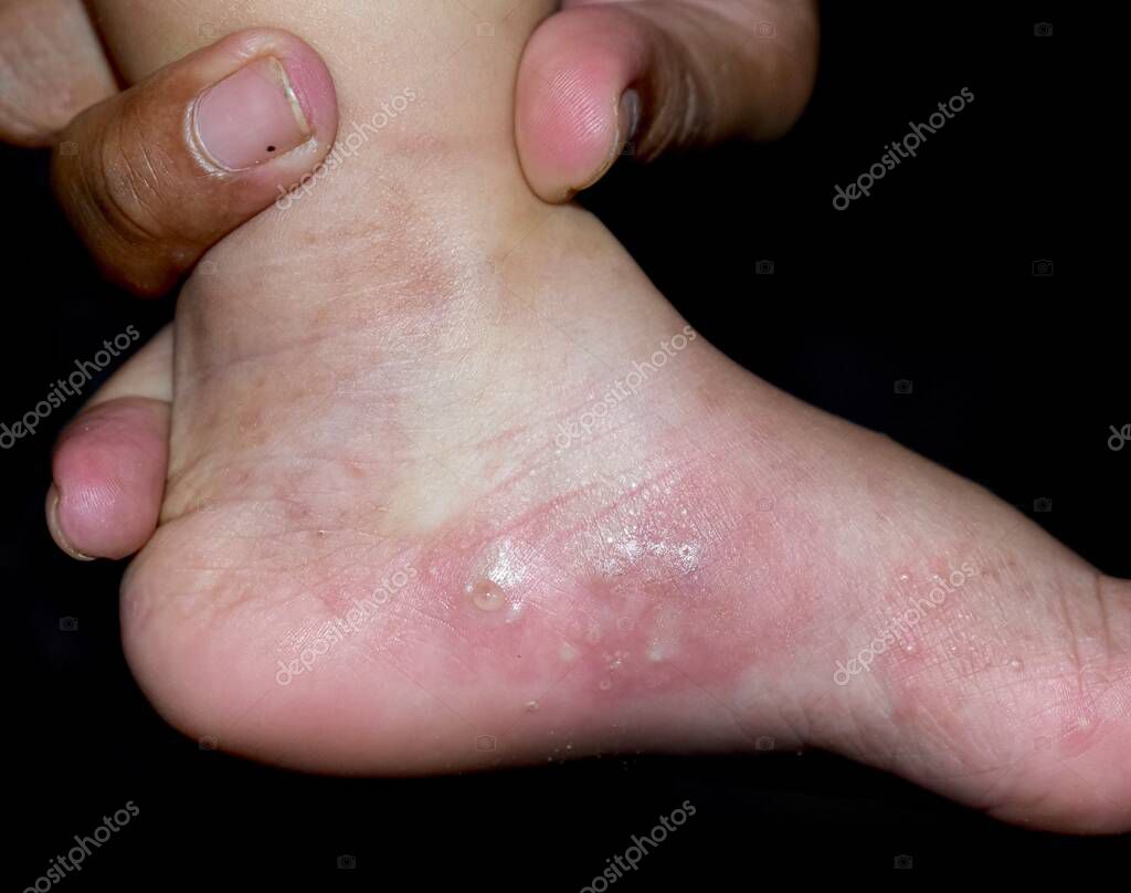 Infestación por sarna con infección bacteriana secundaria o superpuesta ...