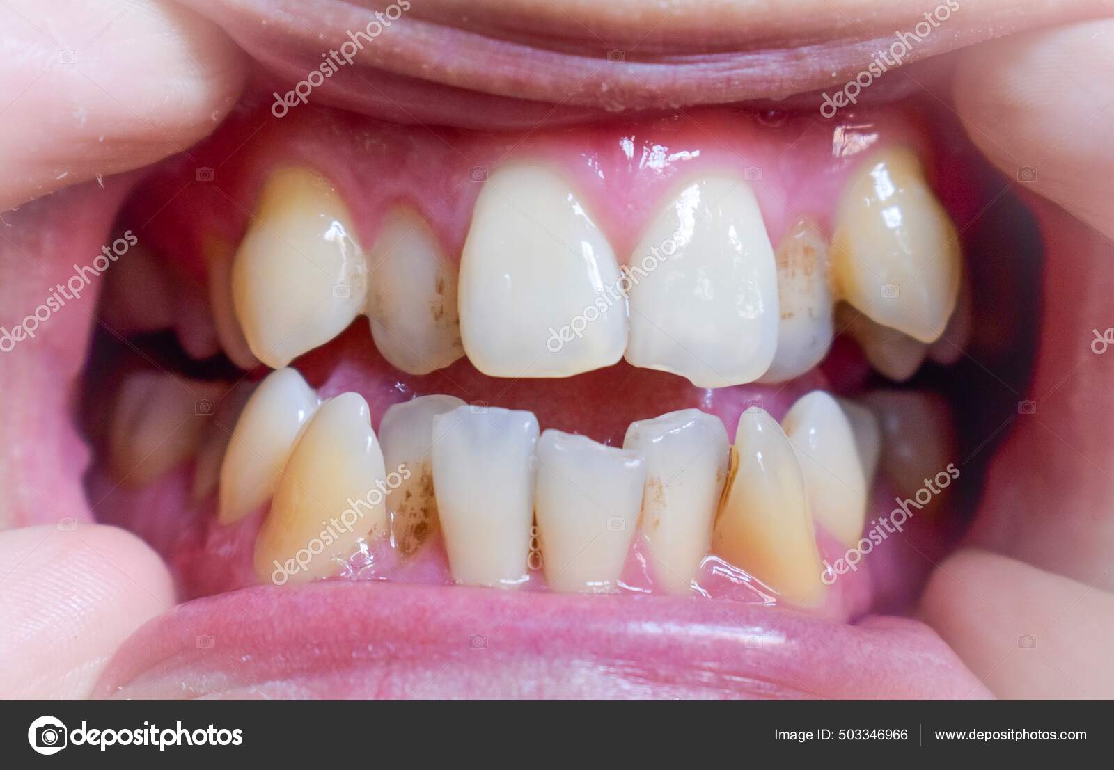 Stacked Overlapping Teeth Asian Man Also Called Crowded Teeth Closeup ...