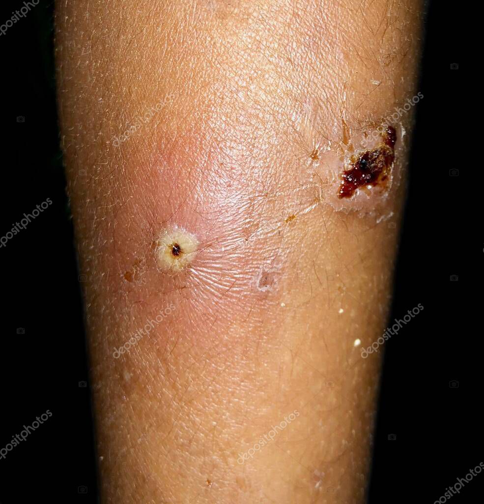 Furúnculos o infección estafilocócica en la pierna del niño asiático ...