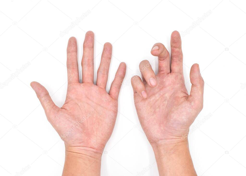 Mano de garra de Ulnar comparada con la mano normal de un joven ...