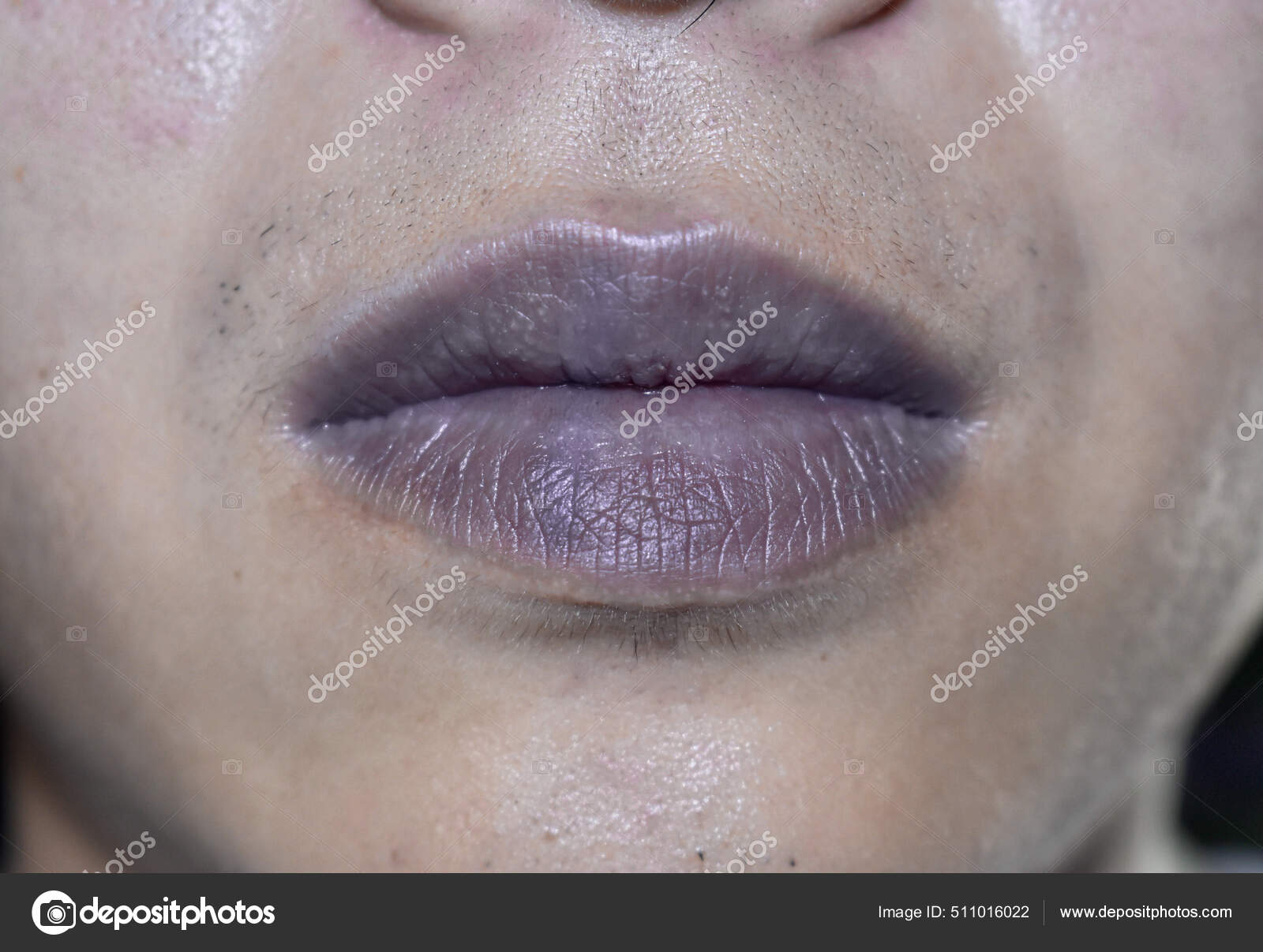 What Is Cyanosis Of The Lips Called