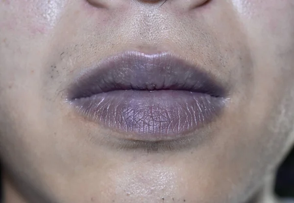 Cyanose images libres de droit, photos de Cyanose | Depositphotos