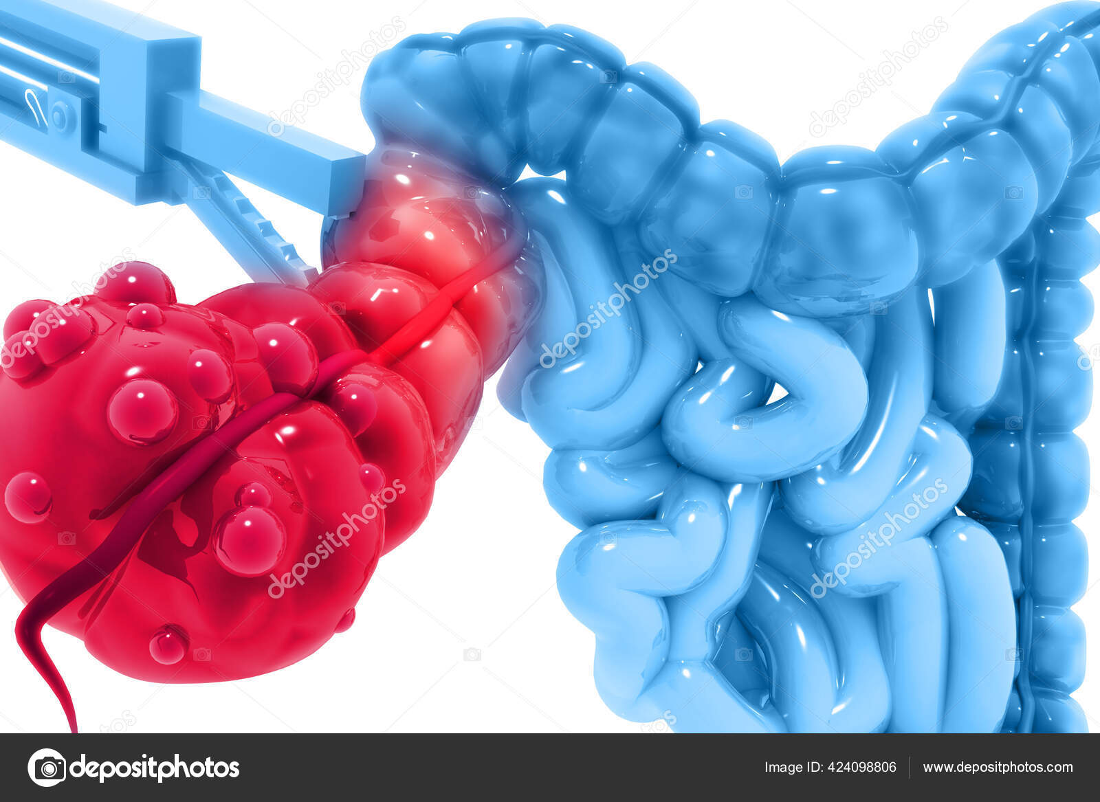 Appendix Surgery White Background Render Stock Photo by ©crytallight ...