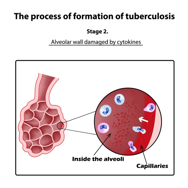 The development of tuberculosis. Stage 4. Infographics. Vector ...