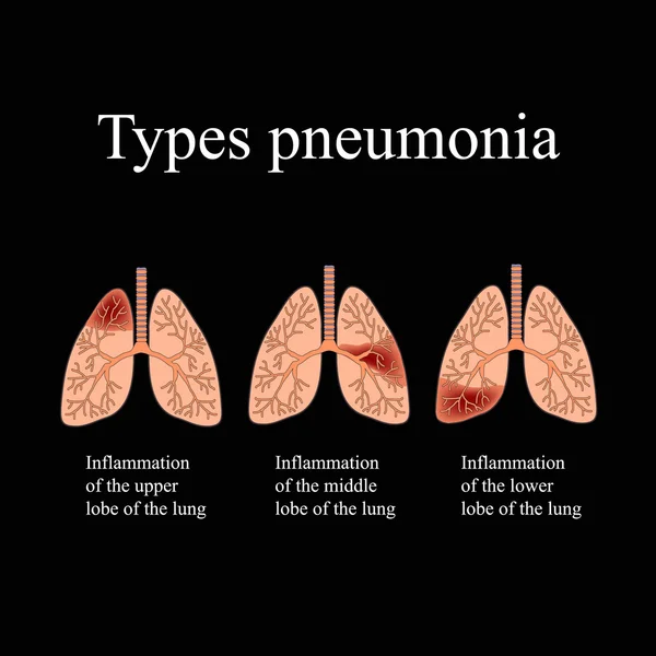 Pneumonia Ribbon Color