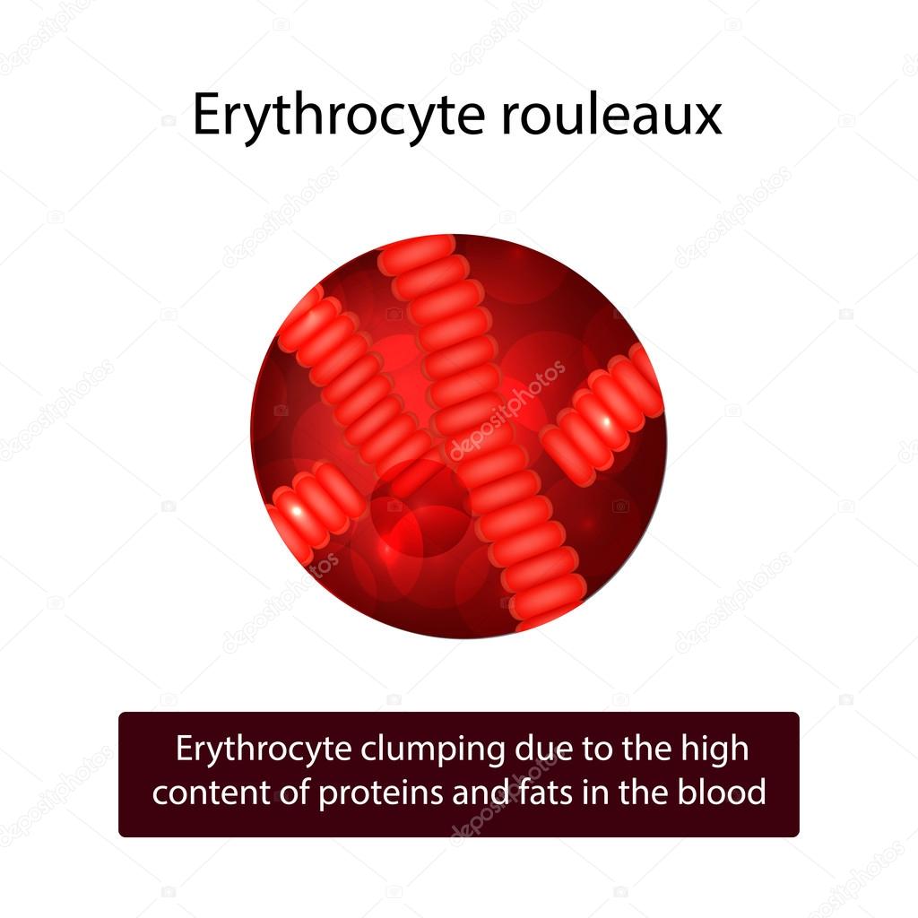 Rouleaux of red blood cells. Erythrocyte clumping due to the high ...