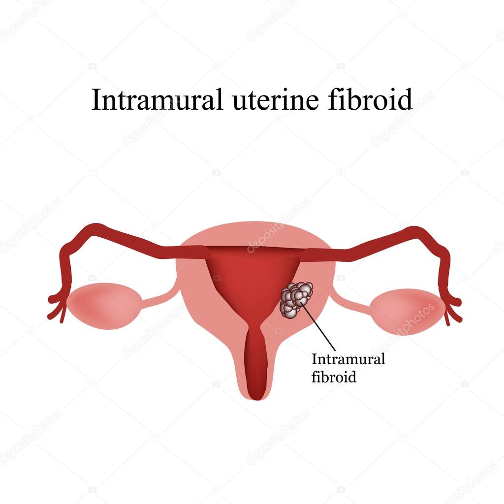 İntramural uterin fibroids. Endometriozis. Infographics. Beyaz arka ...
