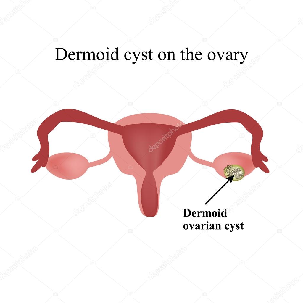 Dermoid Cyst On The Ovary Ovary Infographics Vector Illustration On