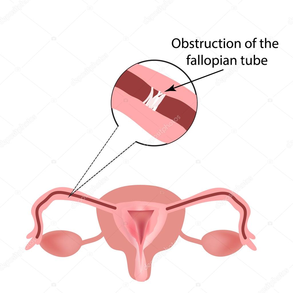 Obstruction of the fallopian tubes. The structure of the pelvic organs ...