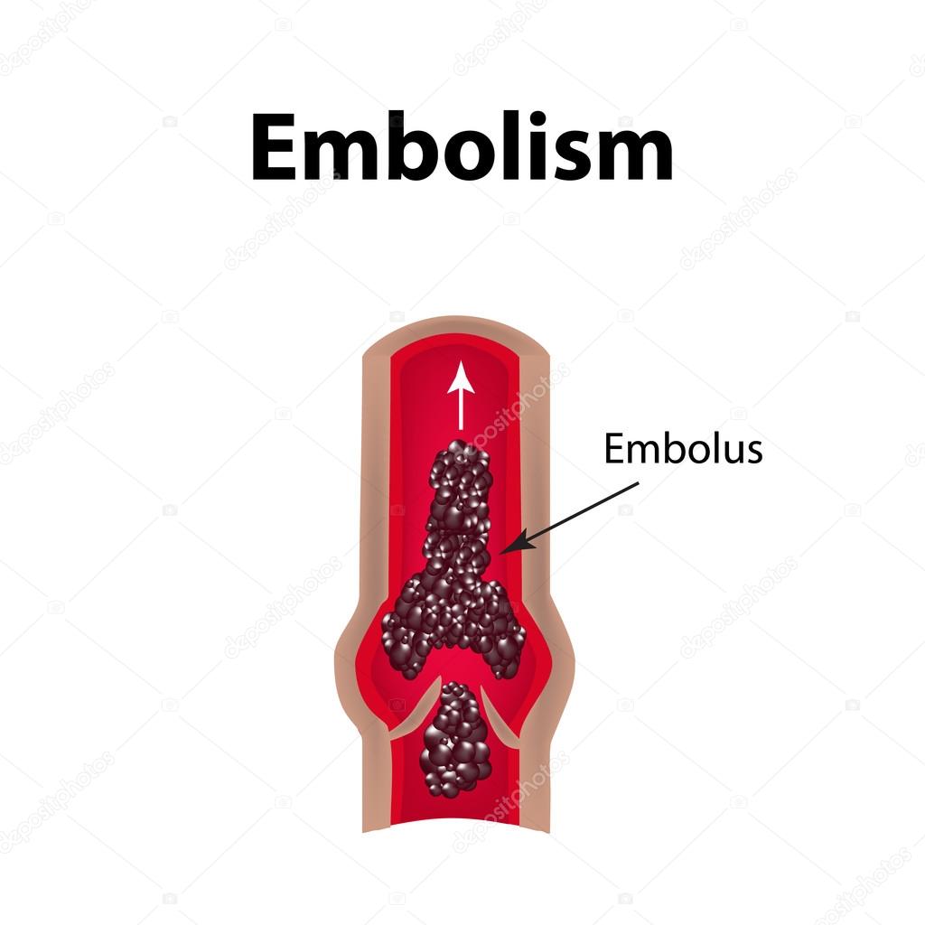 Thrombocytosis. Embolism. Infographics. Vector illustration on isolated ...