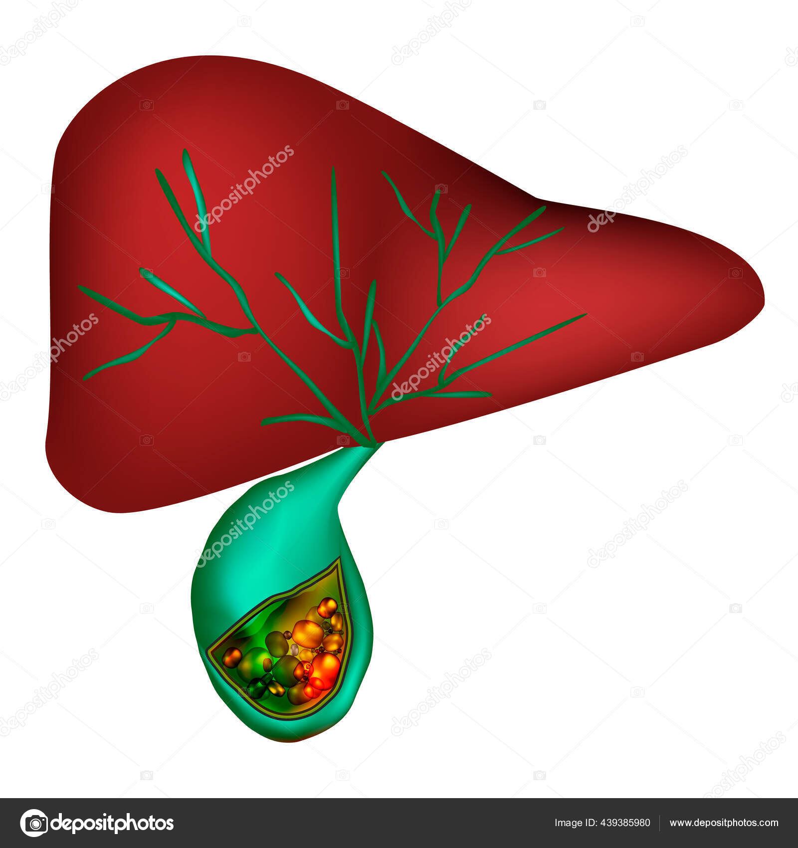 Cálculos biliares. Colelitiasis. Colecistitis. Inflamación de la ...