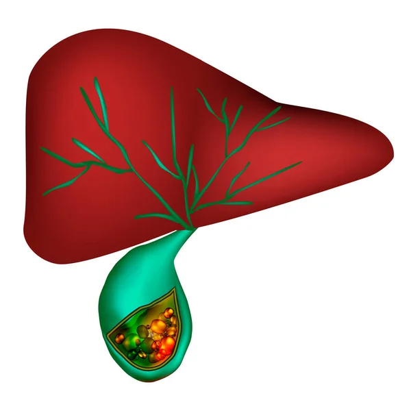 Cálculos biliares. Colelitiasis. Colecistitis. Inflamación de la ...