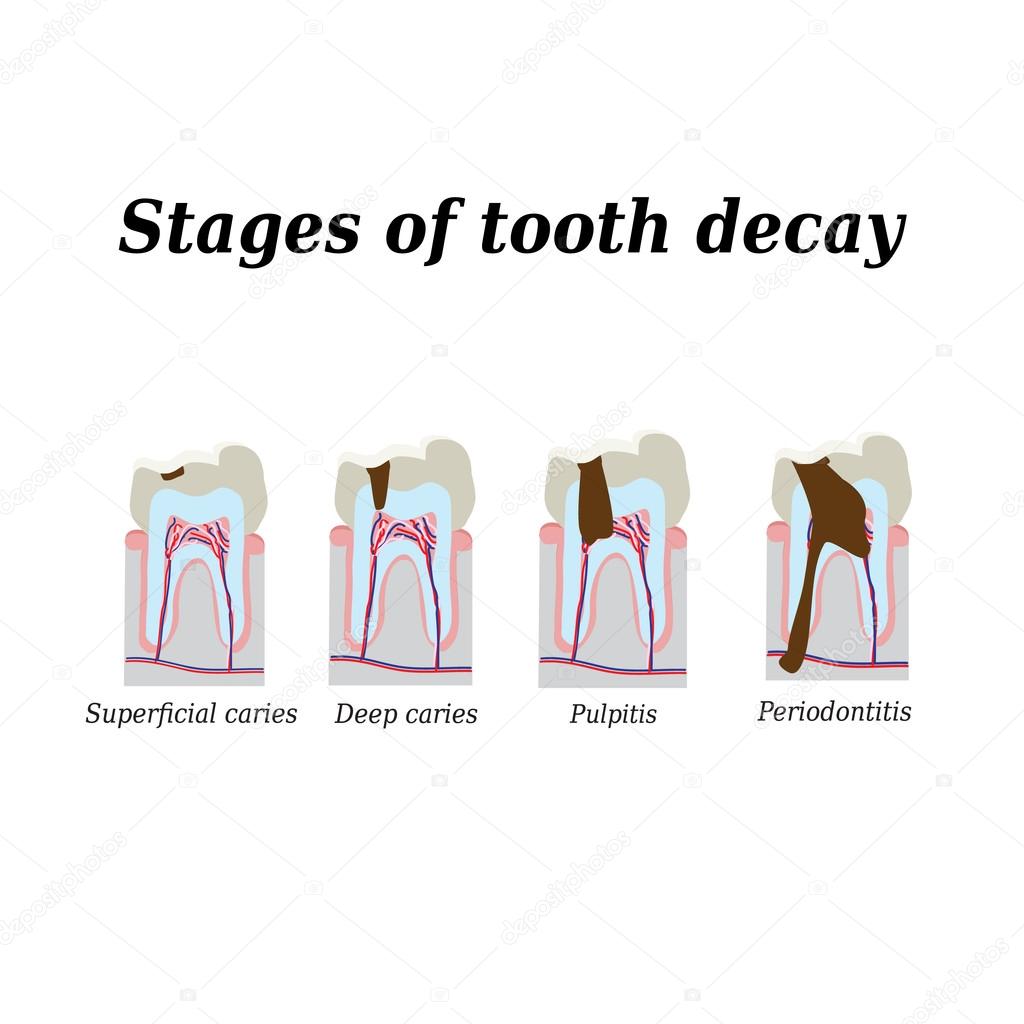 Stages of development of dental caries. Vector illustration on isolated ...