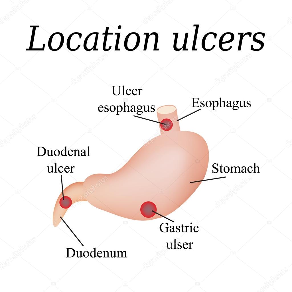 Úlcera de esófago afectada. Úlcera de esófago. Úlcera estomacal ...