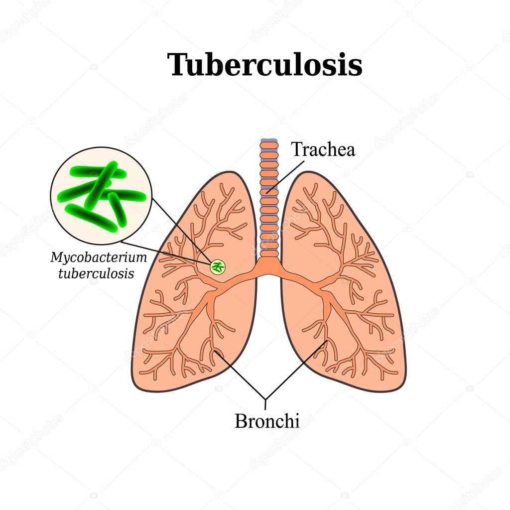 Tuberculosis. Enfermedad pulmonar. Bacilo tubérculo. Ilustración ...