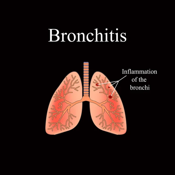 Bronchitis Vector Art Stock Images | Depositphotos