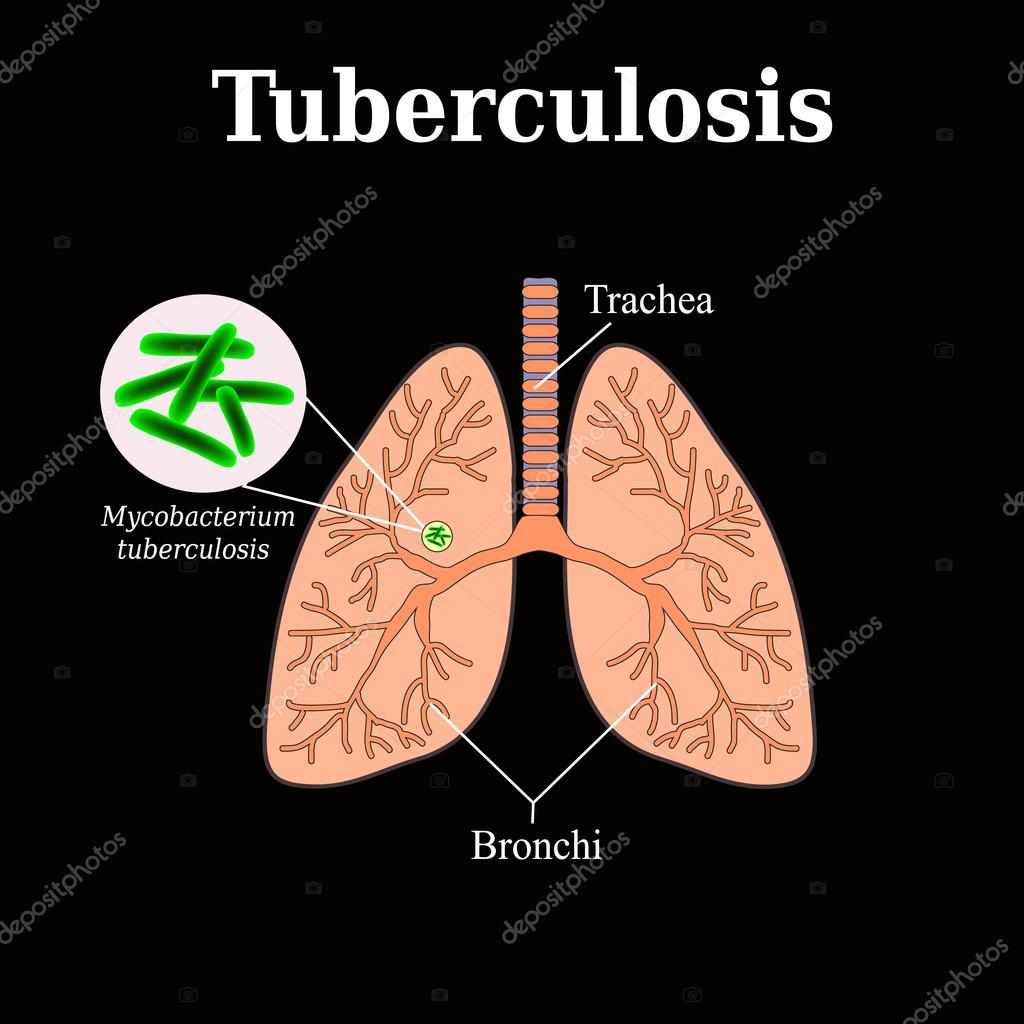 Tuberkulosis. Penyakit paru-paru. Bacillus tubercle. Ilustrasi vektor ...