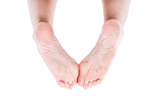 piernas femeninas con piel seca deshidratada sobre secado en primer ...