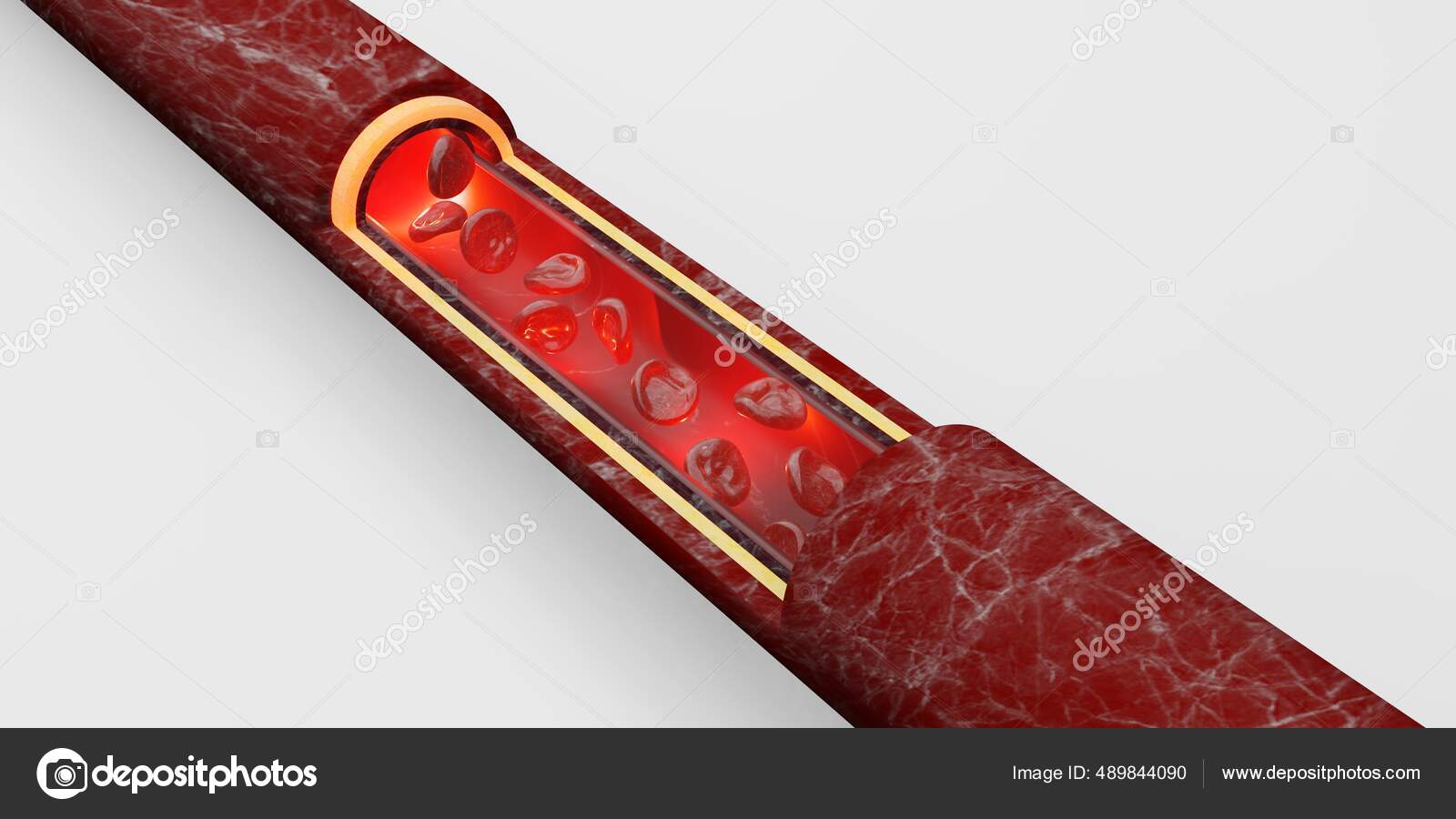 Red Blood Cells Skin Layer Veins Illustration Intravascular Surgery ...