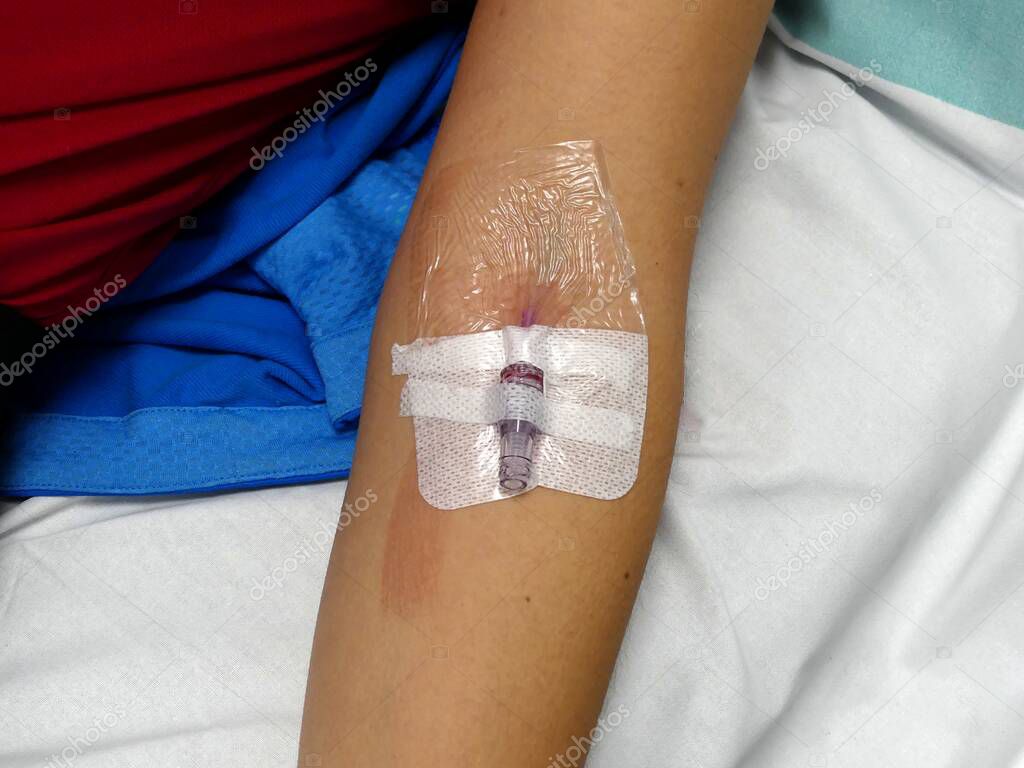 Catéter venoso periférico moderno para perfusión intravenosa en el ...