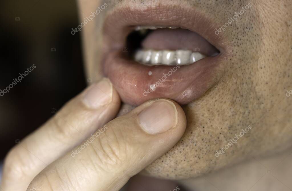 úlceras aftosas recurrentes o aftas, labio dolorido. Estomatitis aftosa ...