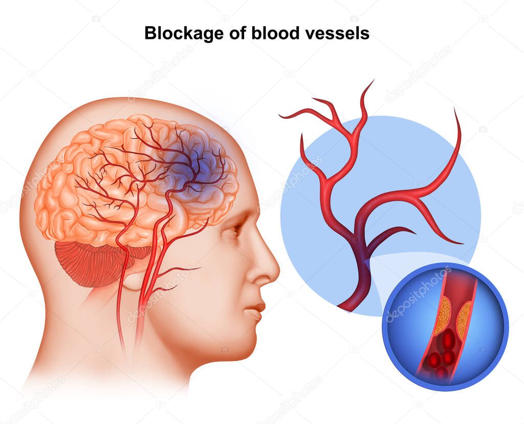 Ilustración médica del bloqueo de las arterias cerebrales 2023