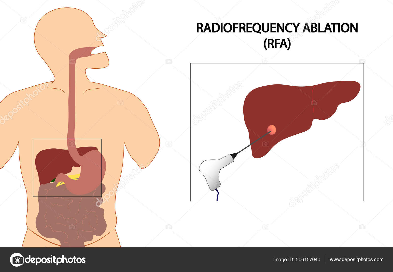 Liver Radiofrequency Ablation Rfa Illustration Liver Cancer Ablation Needle Ablation Stock ...