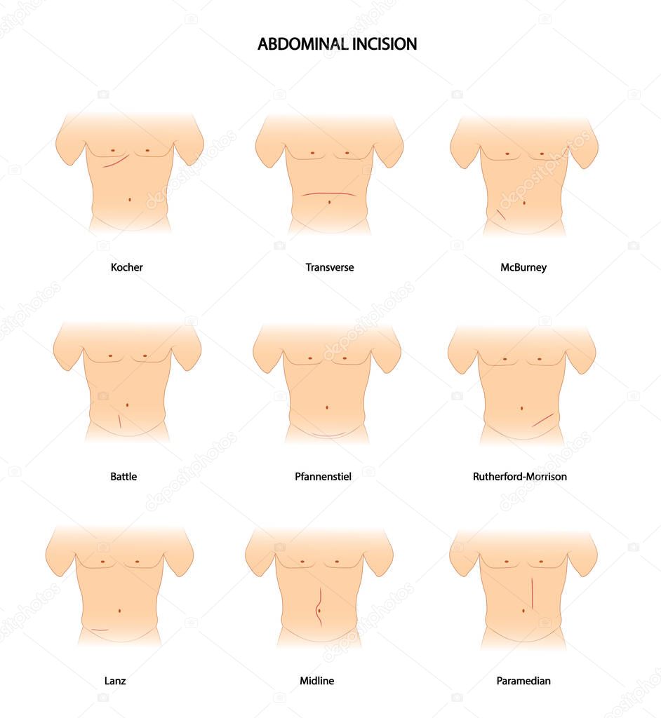 Incisión abdominal. Diferentes tipos de incisión abdominal. Incisión ...