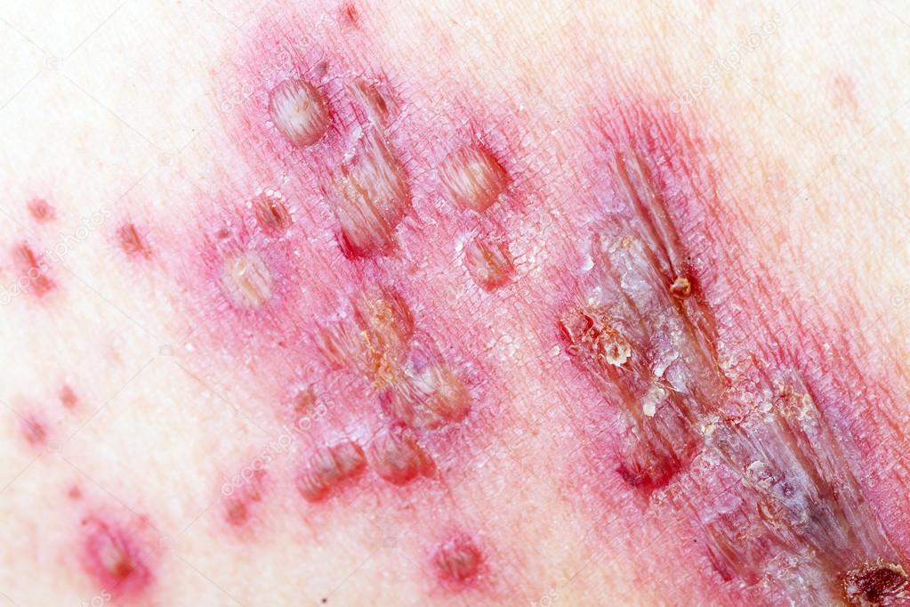 Herpes Zoster (Shingles) — Stock Photo © supersaiyan3 #76997125