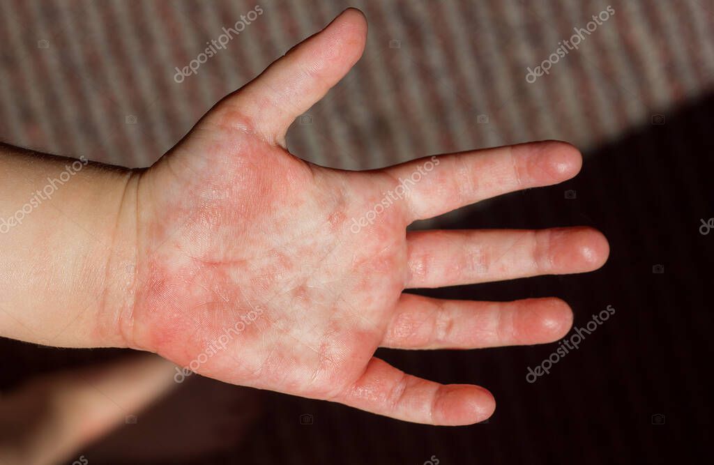 Erupción roja en las manos de los niños sobre un fondo blanco, una reacción alérgica y ...