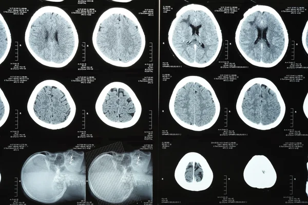 Brain CT with Scout — Stock Photo © Lawcain #67906511