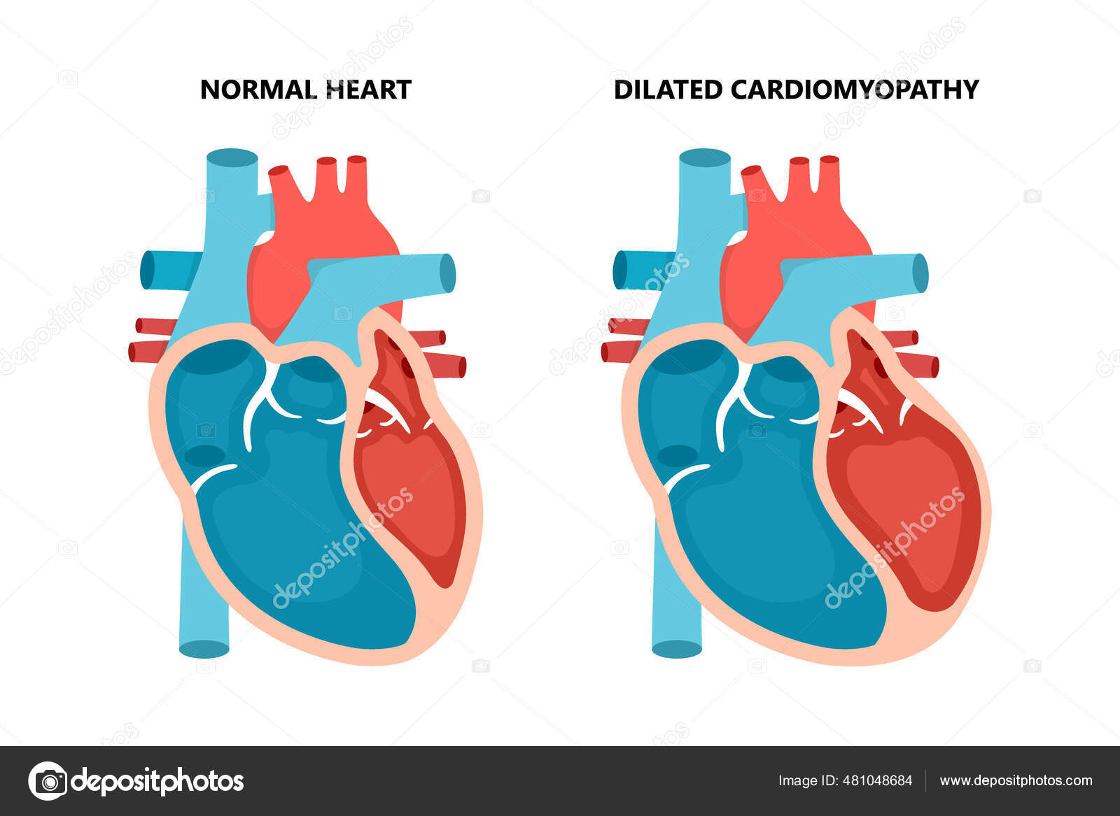 Dilated cardiomyopathy with cross-section view. Human heart muscle ...