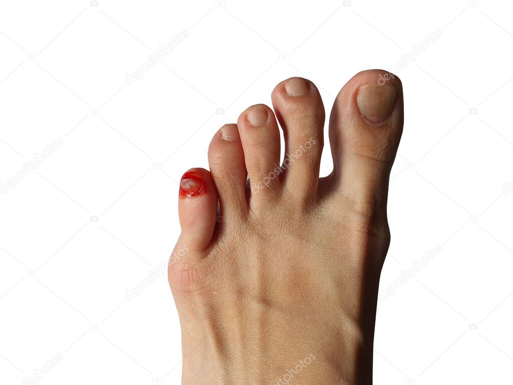 Imagen de una uña del pie con una herida por el impacto tan fuerte que ...