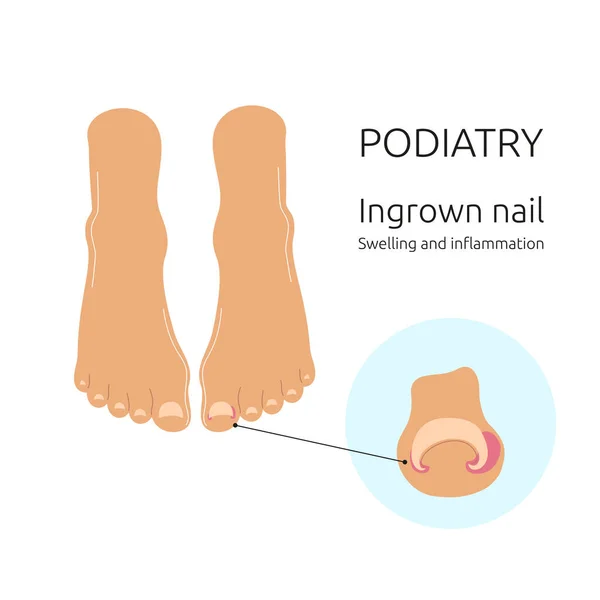 73 An ingrown toenail Vector Images, An ingrown toenail Illustrations ...