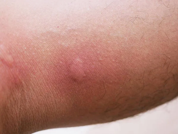 Skin Colored Bumps On Elbows