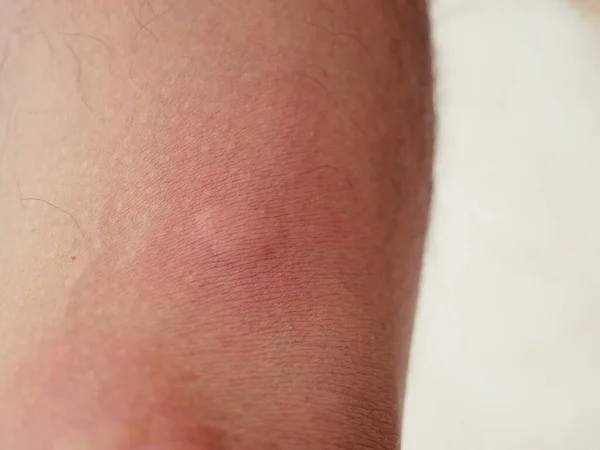Insect bite reaction Stock Photos, Royalty Free Insect bite reaction ...