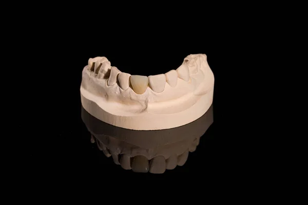 Protese sobre implante Stock Photos, Royalty Free Protese sobre ...