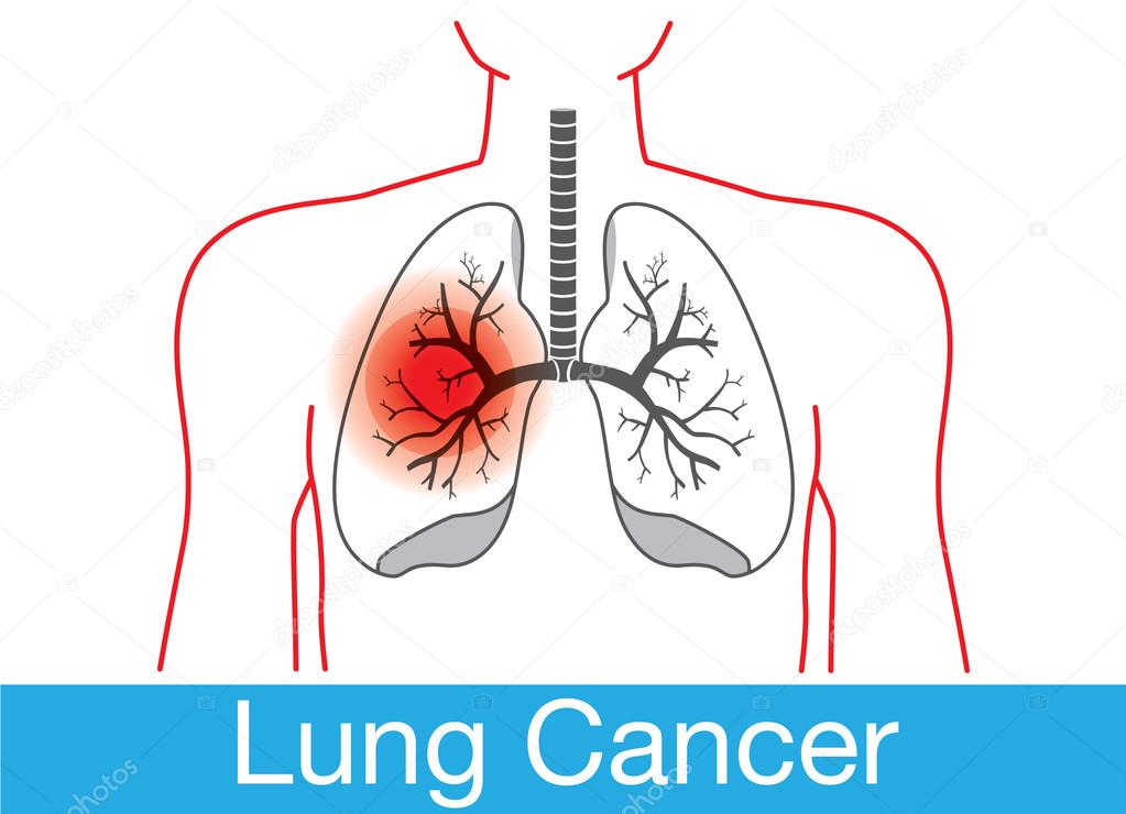 Lung Cancer Cell Diagram