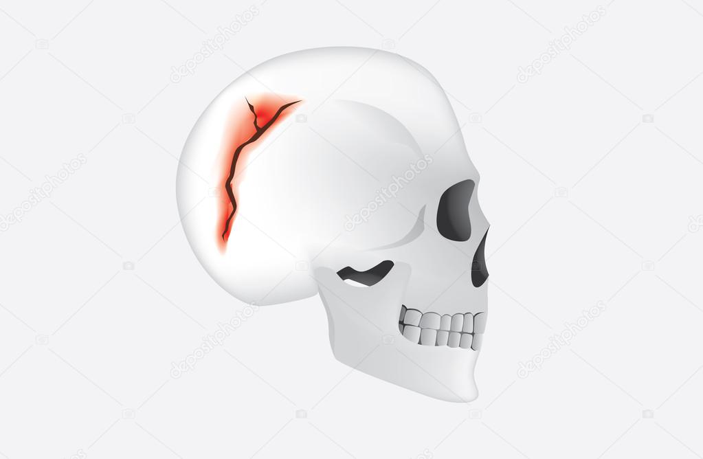Human Skull Fracture Stock Vector Image by ©solar22 #101584004