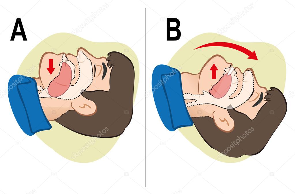 Reanimación de primeros auxilios (RCP), limpieza de la respiración ...