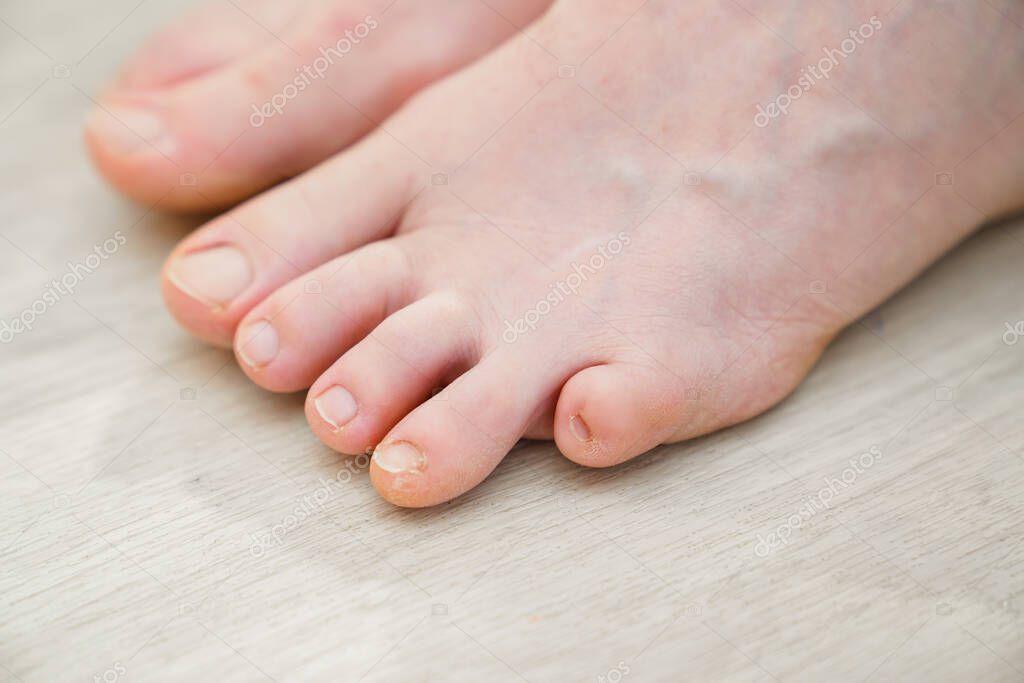 pie inusual. dedo meñique muy pequeño en la pierna. anomalías ...