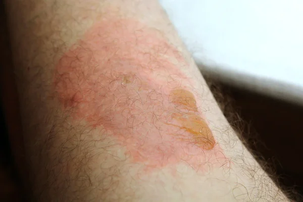 Burn injuries Stock Photos, Royalty Free Burn injuries Images ...