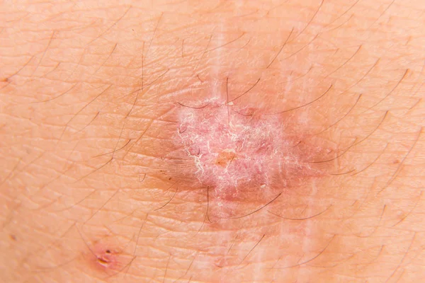 Punch biopsy scar Stock Photos, Royalty Free Punch biopsy scar Images ...