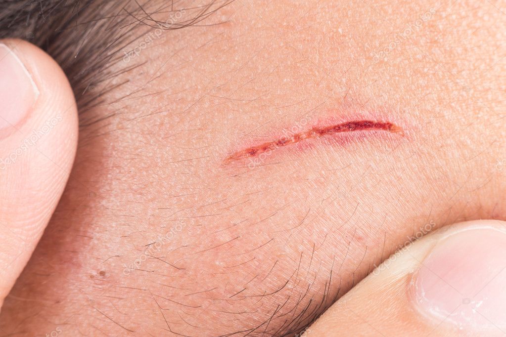 Deep Skin Cut